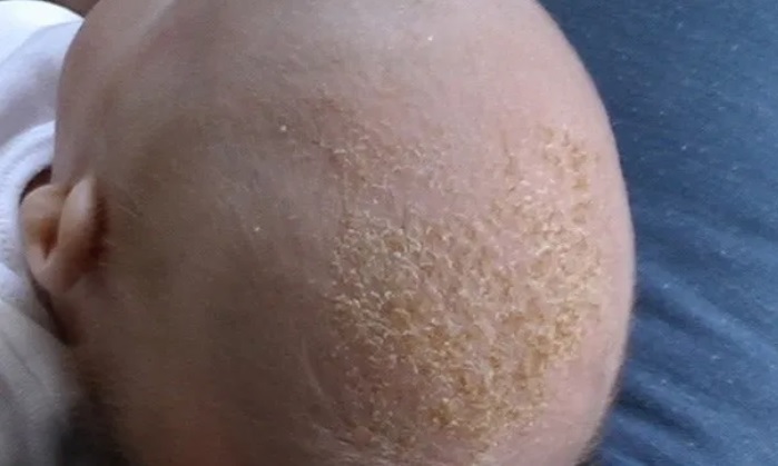 Dermatitis Seboroik: Gejala, Penyebab, dan Cara Mengobatinya
